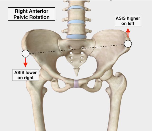 A Twisted Pelvis, also called Pelvic Torsion, Can Be Corrected